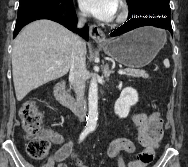hernie hiatale - Clinique chirurgie digestive royan